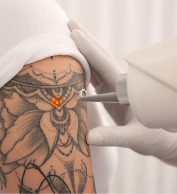 Professional Certificate in Laser Tattoo Removal | AACDS